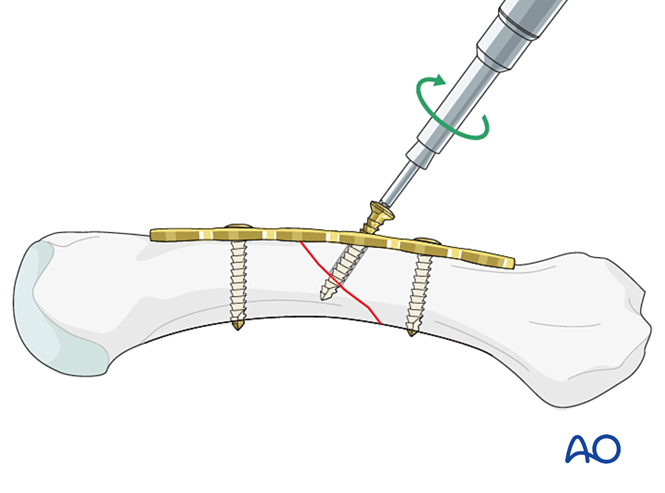 Compression plating with/without lag screw for Simple oblique fracture ...