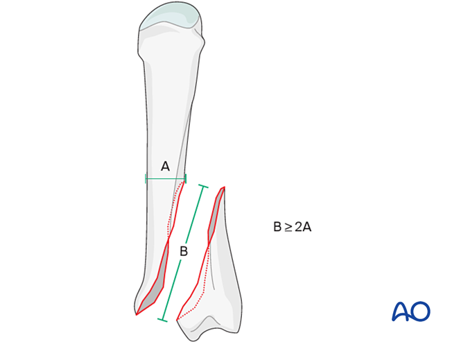 Lag-screw fixation for Extraarticular fracture of the proximal end segment