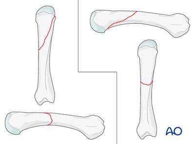 Lag-screw fixation for Extraarticular fracture of the distal end segment