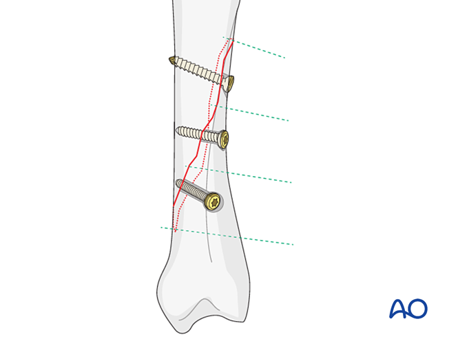 Lag-screw fixation for Simple oblique fracture of the diaphysis
