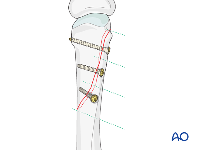 Lag-screw fixation for Extraarticular fracture of the distal end segment