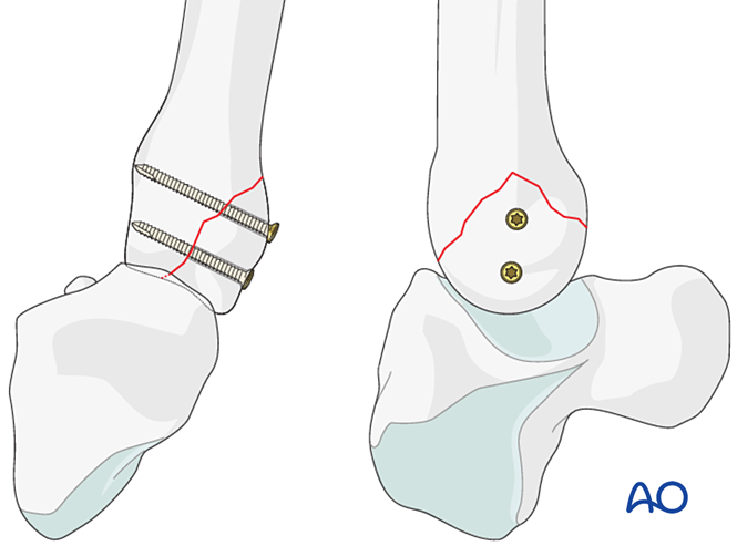 Lag-screw fixation