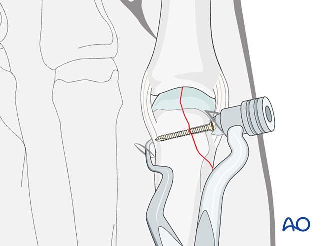 Lag-screw fixation for Articular fracture of the distal end segment