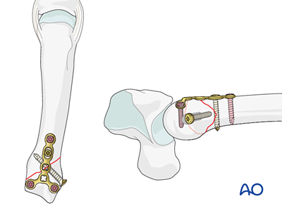 Lag-screw fixation with a neutralization plate for Extraarticular ...