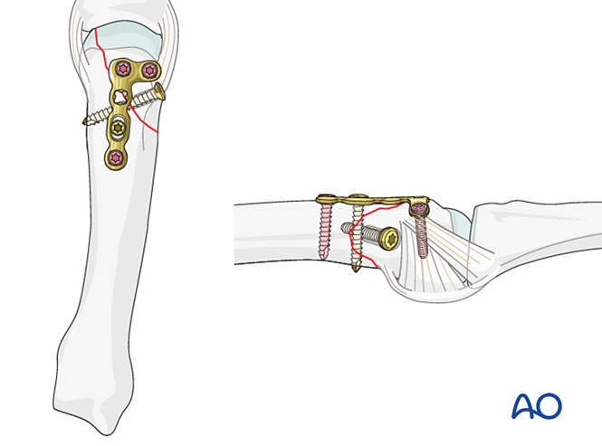 Lag-screw fixation with a neutralization plate for Articular fracture ...