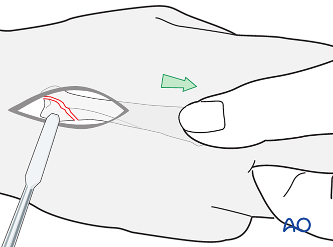 Lag-screw fixation with a neutralization plate for Partial articular ...