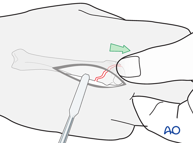 Lag-screw fixation with a neutralization plate for Articular fracture ...
