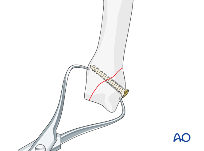 Lag-screw fixation with a neutralization plate for Partial articular ...