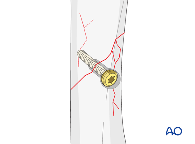 Lag-screw fixation with a neutralization plate for Simple oblique ...