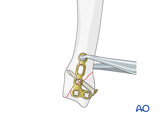 Lag-screw fixation with a neutralization plate for Partial articular ...