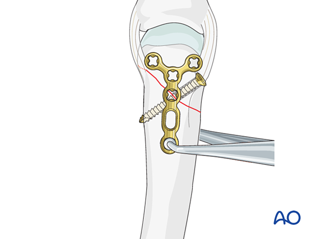 Lag-screw fixation with a neutralization plate for Extraarticular ...