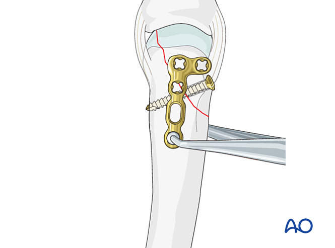 Lag-screw fixation with a neutralization plate for Articular fracture ...