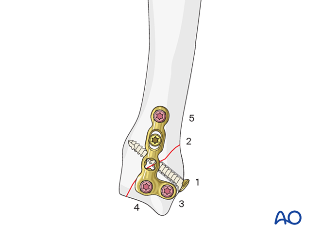 Lag-screw fixation with a neutralization plate for Partial articular ...