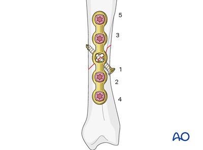 Lag-screw fixation with a neutralization plate for Simple oblique ...