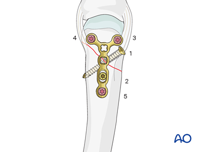 Lag-screw fixation with a neutralization plate for Extraarticular ...