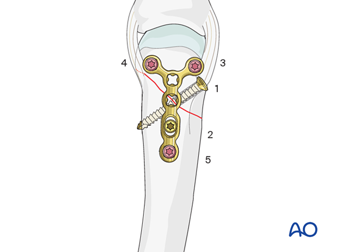Lag-screw fixation with a neutralization plate for Extraarticular ...