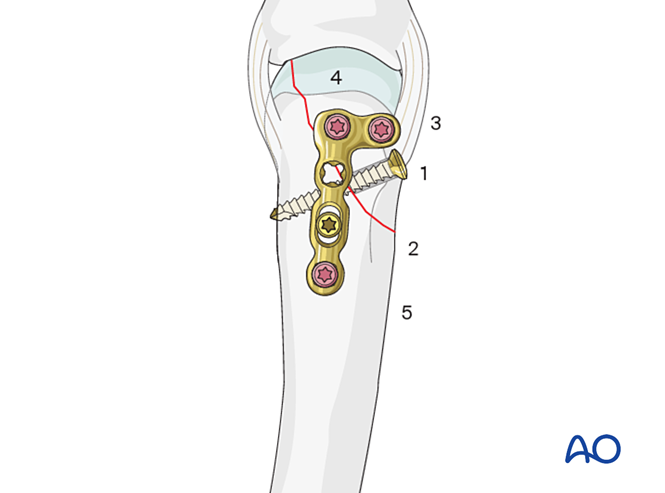 Lag-screw fixation with a neutralization plate for Articular fracture ...