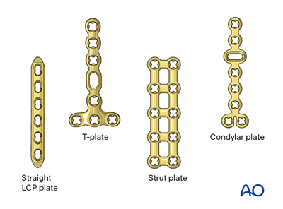 Bridge plating for Wedge or multifragmentary fracture of the diaphysis