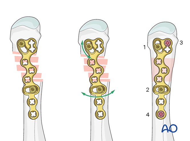 Bridge plating for Extraarticular fracture of the distal end segment