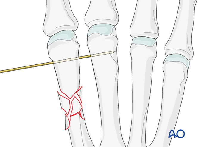 Bridge plating for Extraarticular fracture of the proximal end segment