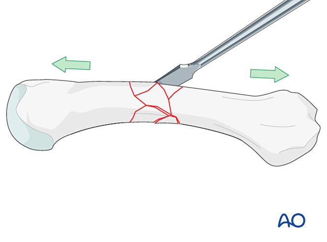 Bridge plating for Wedge or multifragmentary fracture of the diaphysis