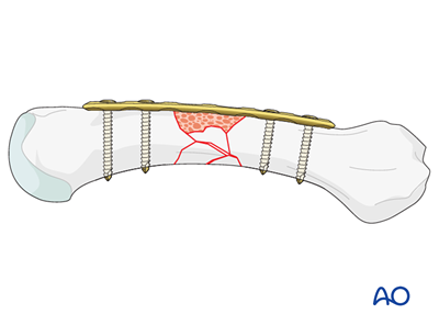 Bridge plating for Wedge or multifragmentary fracture of the diaphysis