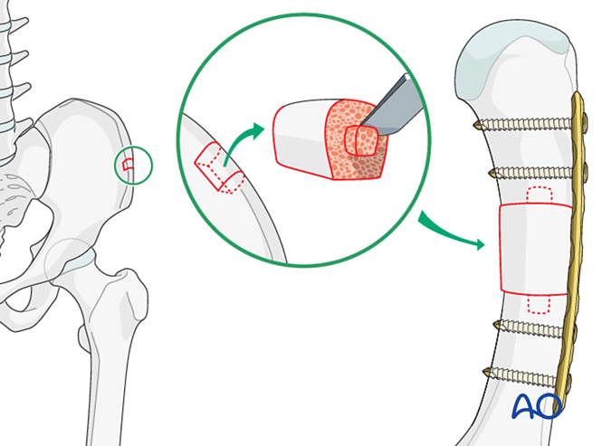 Bridge plating for Wedge or multifragmentary fracture of the diaphysis