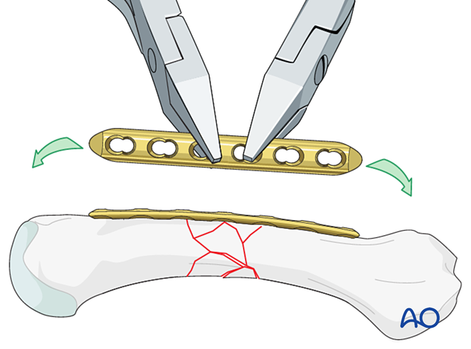 Bridge plating for Wedge or multifragmentary fracture of the diaphysis