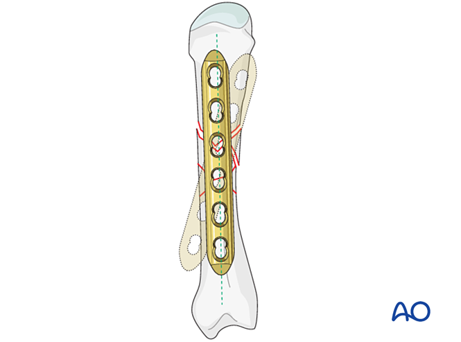 Bridge plating for Wedge or multifragmentary fracture of the diaphysis
