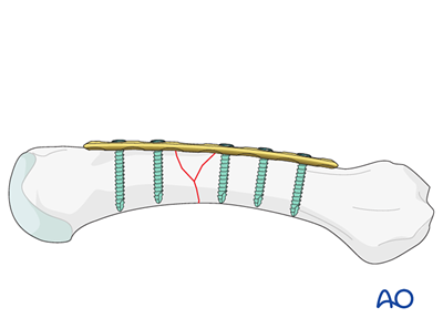 Bridge plating for Wedge or multifragmentary fracture of the diaphysis