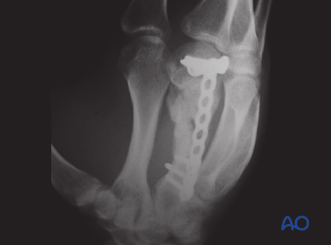 Bridge plating for Wedge or multifragmentary fracture of the diaphysis