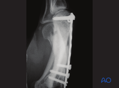 Bridge plating for Wedge or multifragmentary fracture of the diaphysis