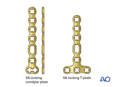 Bridge plating for Extraarticular fracture of the proximal end segment