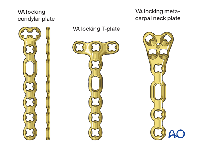 Bridge plating for Extraarticular fracture of the distal end segment