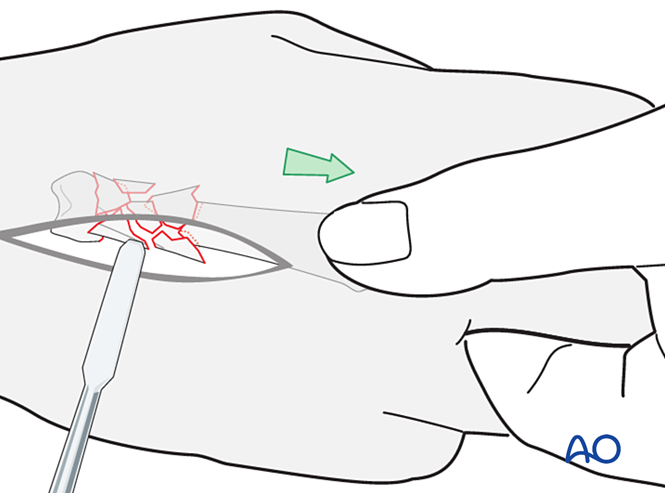 Bridge plating for Extraarticular fracture of the proximal end segment