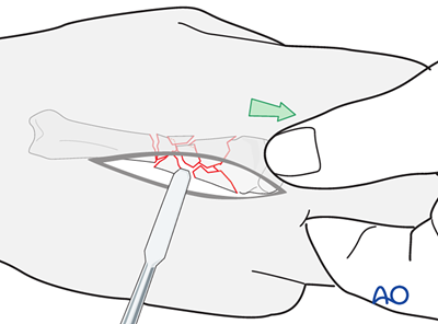 Bridge plating for Extraarticular fracture of the distal end segment
