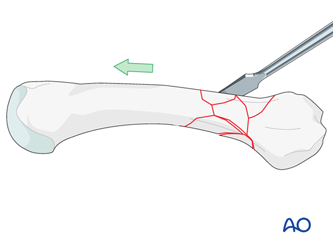 Bridge plating for Extraarticular fracture of the proximal end segment
