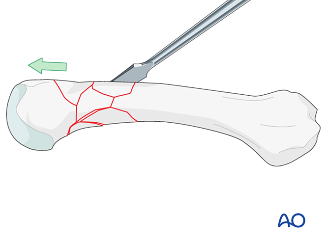Bridge plating for Extraarticular fracture of the distal end segment