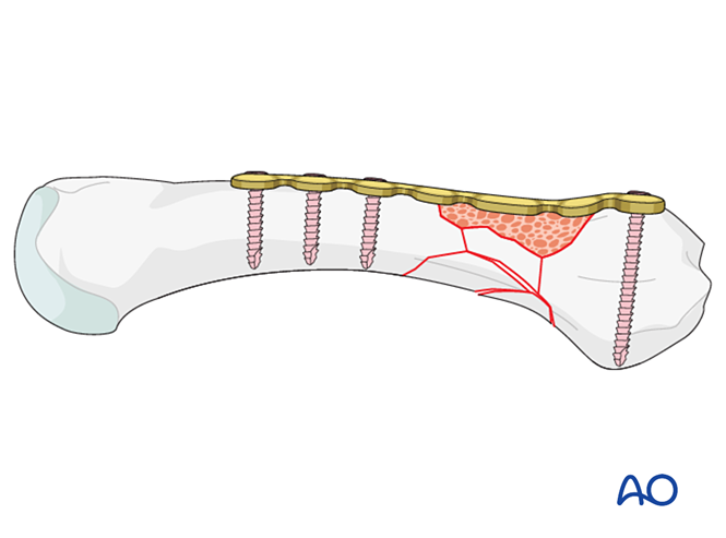 Bridge plating for Extraarticular fracture of the proximal end segment