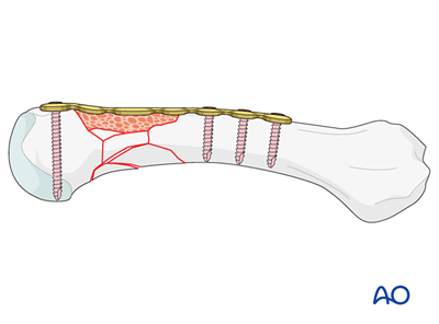 Bridge plating for Extraarticular fracture of the distal end segment
