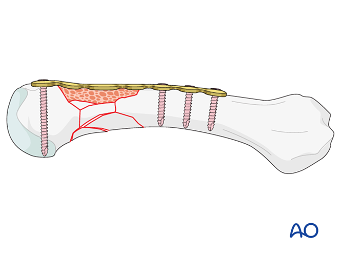 Bridge plating for Extraarticular fracture of the distal end segment