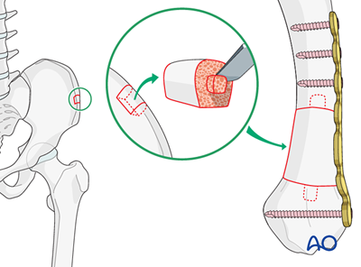 Bridge plating for Extraarticular fracture of the proximal end segment