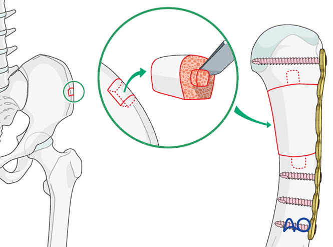 Bridge plating for Extraarticular fracture of the distal end segment