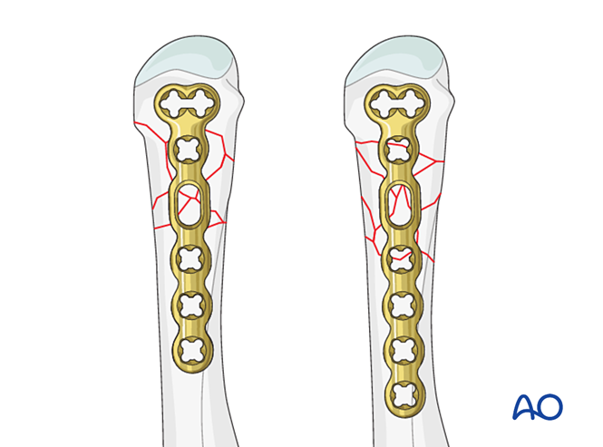 Bridge plating for Extraarticular fracture of the distal end segment