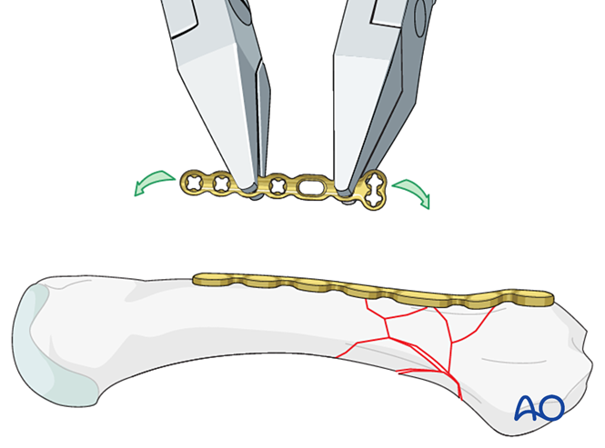 Bridge plating for Extraarticular fracture of the proximal end segment