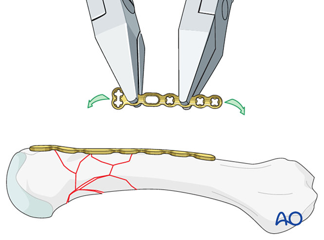 Bridge plating for Extraarticular fracture of the distal end segment