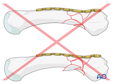 Bridge plating for Extraarticular fracture of the proximal end segment