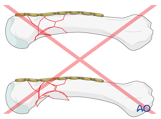 Bridge plating for Extraarticular fracture of the distal end segment