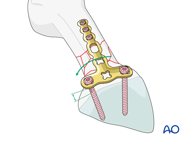 Bridge plating for Extraarticular fracture of the proximal end segment