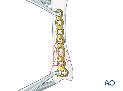 Bridge plating for Extraarticular fracture of the proximal end segment